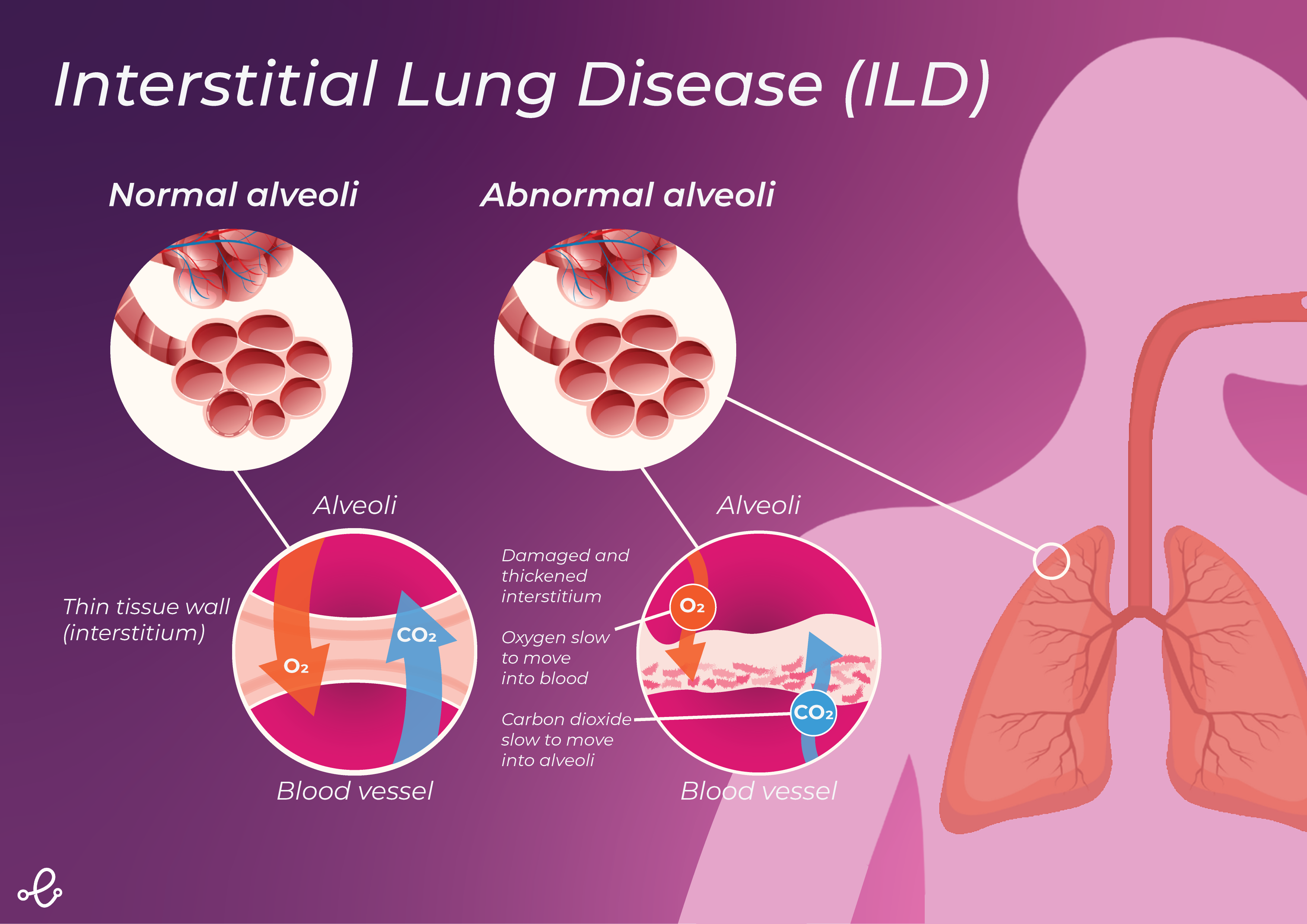 The ILD Patient Journey And What To Expect ElectronRx The ILD Patient Journey And What To Expect ElectronRx